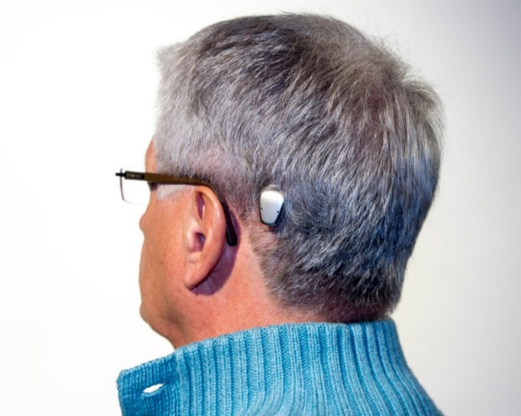 Bone conduction implant – The Royal Victorian Eye and Ear Hospital